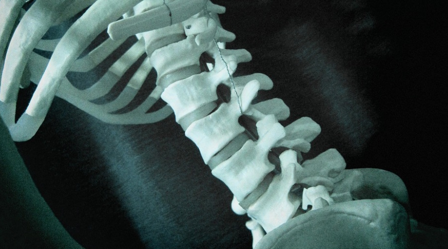 Sandoz files biosimilar of Amgen osteoporosis drug in US | pharmaphorum