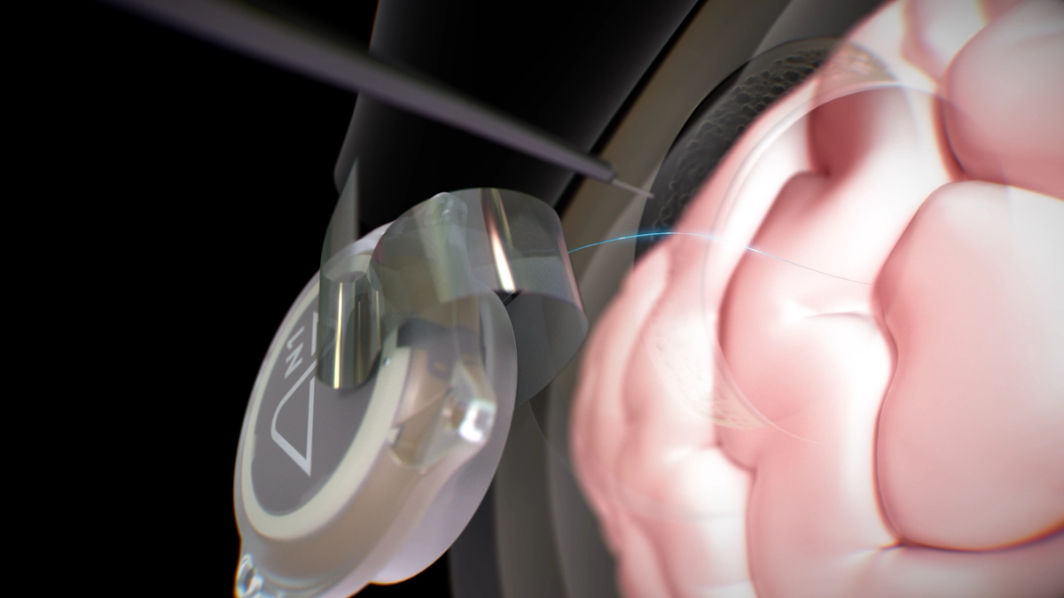 Neuralink gets okay for its first international trial | pharmaphorum