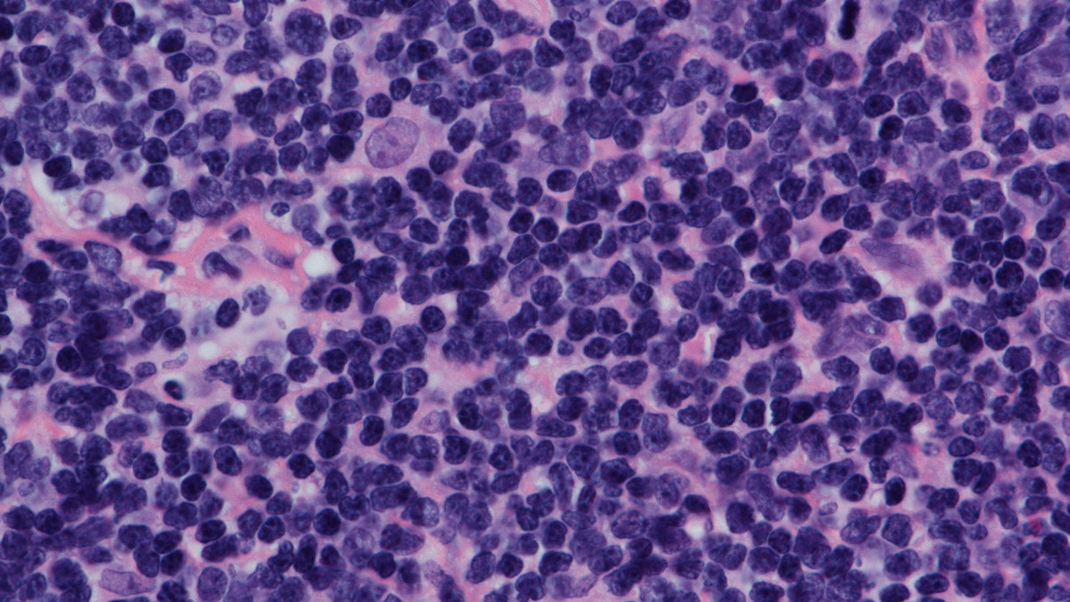 AZ's Calquence gets first-line OK in mantle cell lymphoma | pharmaphorum