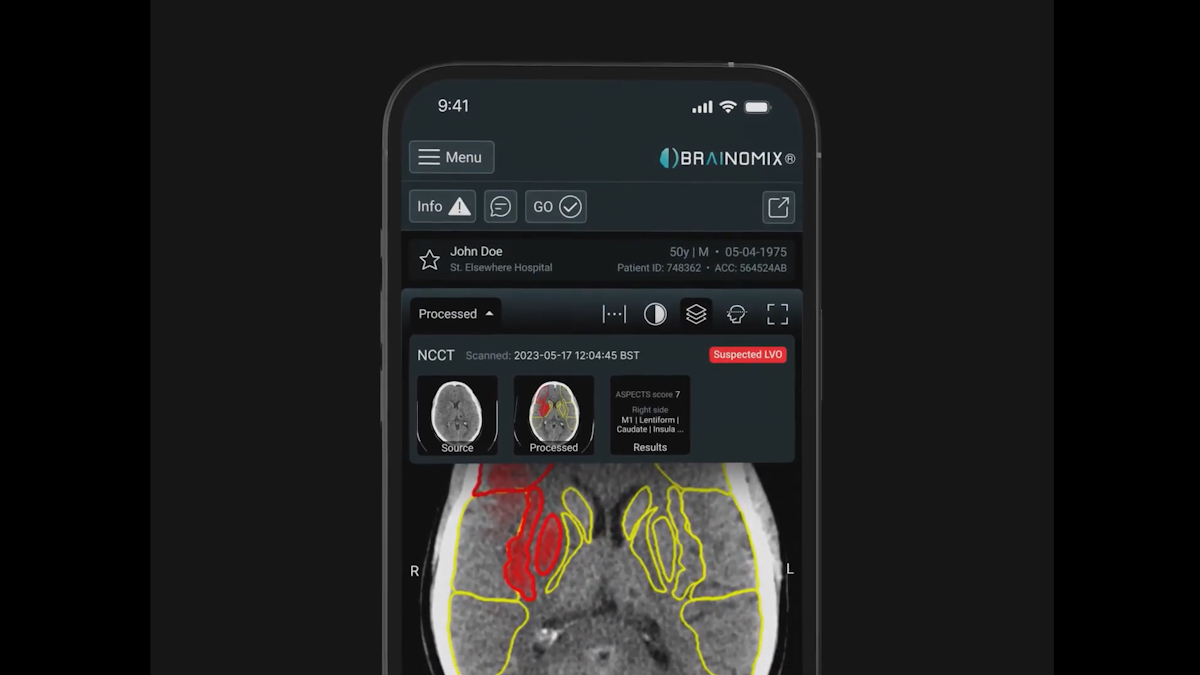 FDA nod broadens use of Brainomix's stroke AI | pharmaphorum