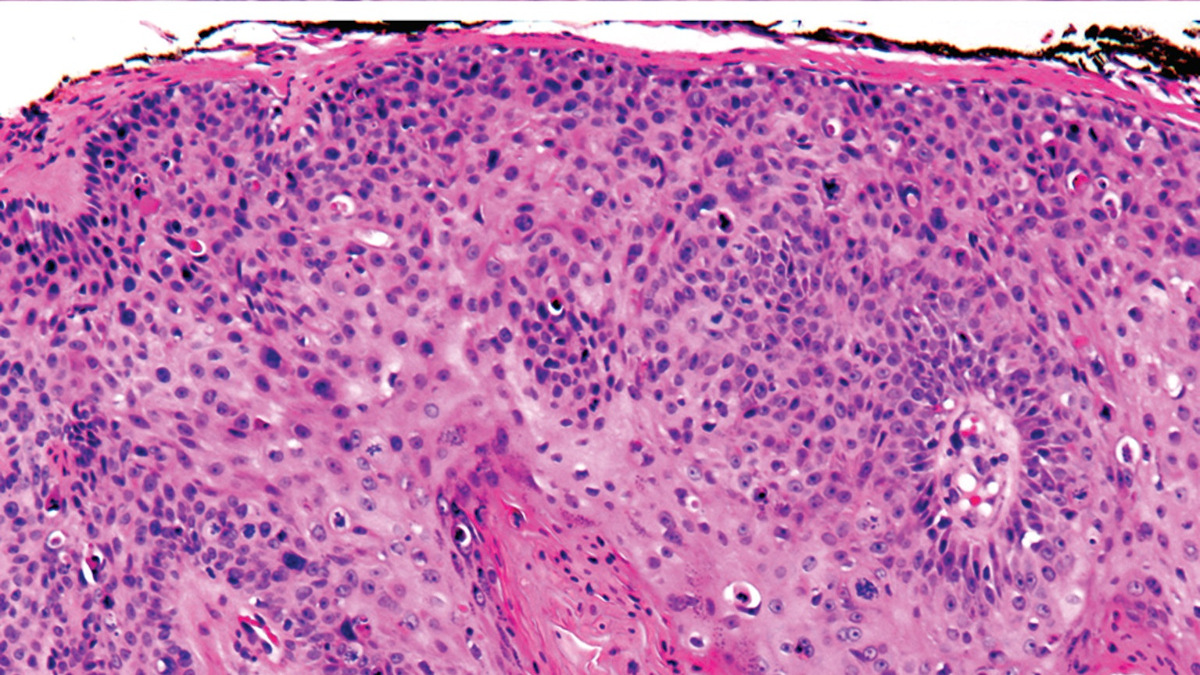 Regeneron's Libtayo stakes out new territory in skin cancer | pharmaphorum