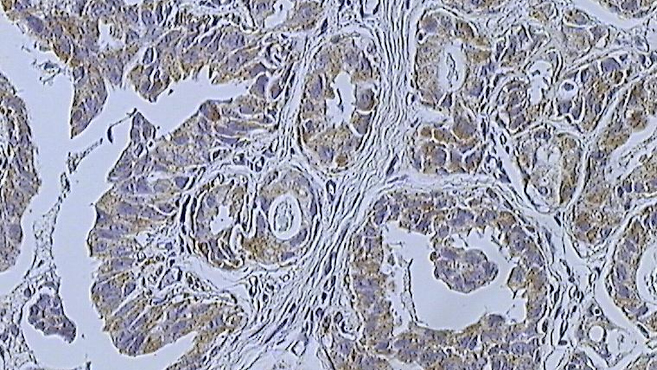 EU starts review of first-line Enhertu for breast cancer | pharmaphorum