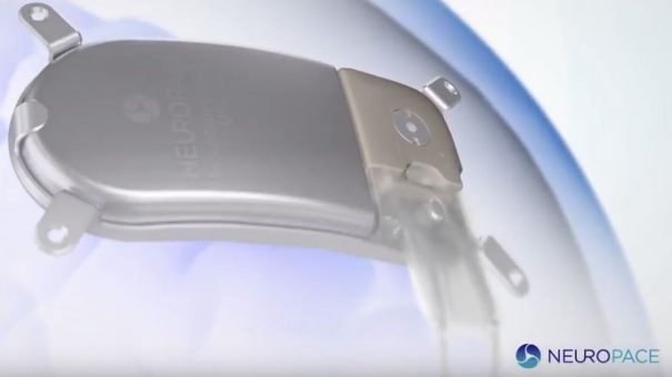 NeuroPace brain implant reduces epilepsy seizures in long-term trial