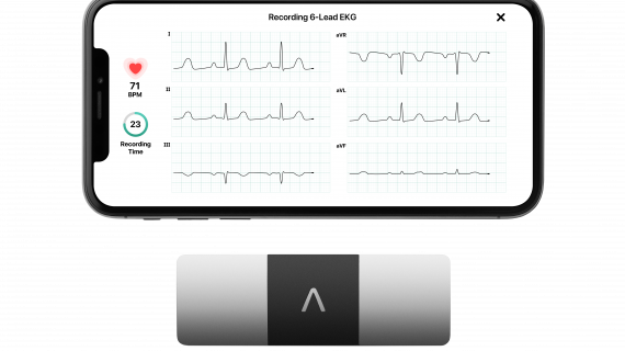 AliveCor launches six-lead ECG smartphone device in UK
