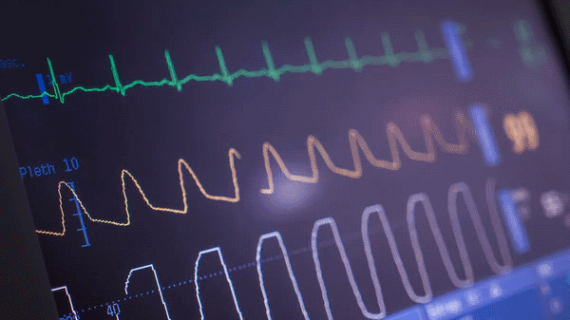 AI study will help select AFib patients for shock treatment